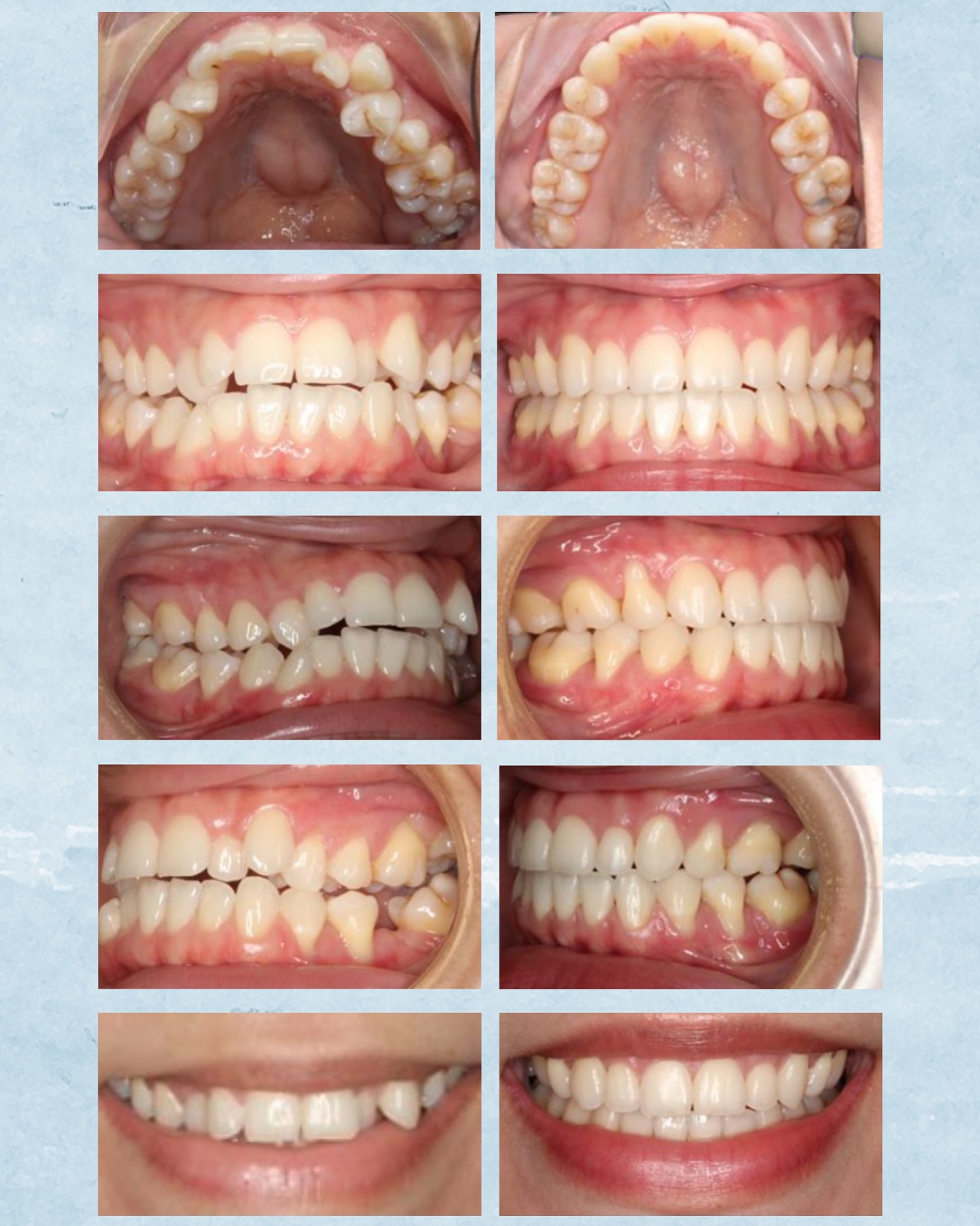 MARPE Procedure For Narrow Maxilla at our Orthodontic Dental Clinic