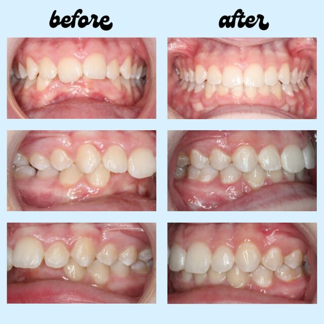 MARPE Procedure For Narrow Maxilla at our Orthodontic Dental Clinic
