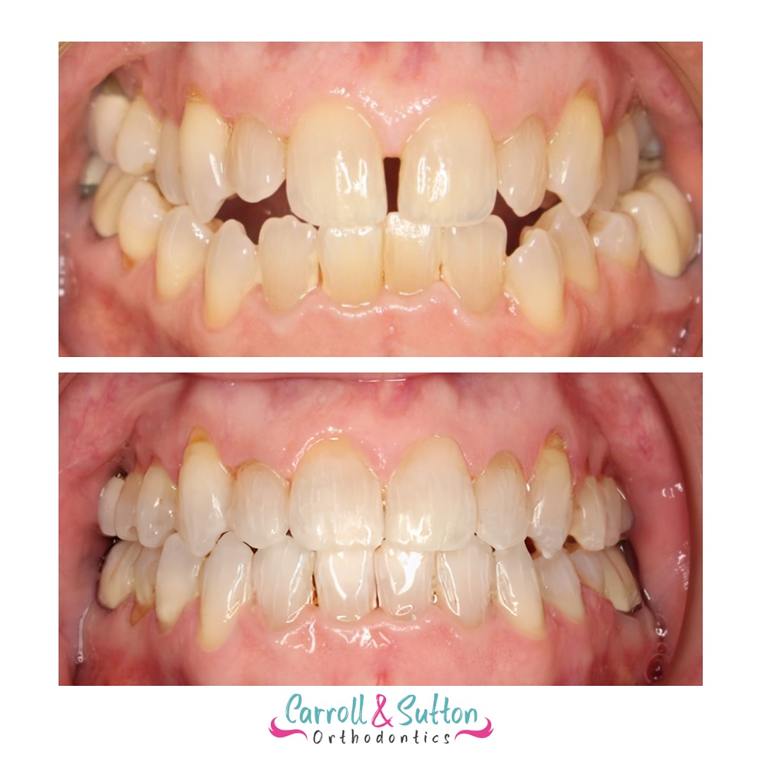 MARPE Procedure For Narrow Maxilla at our Orthodontic Dental Clinic